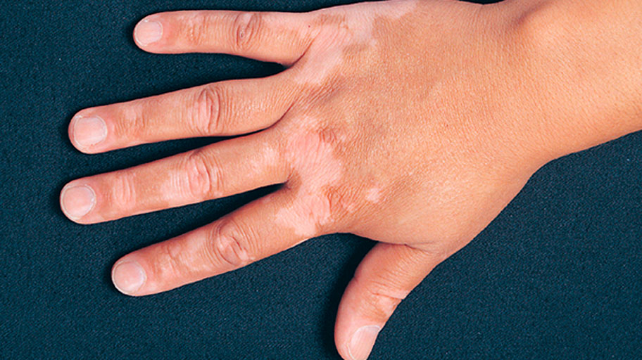 Vitiligo Fundaci n Mexicana Para La Dermatolog a A C 